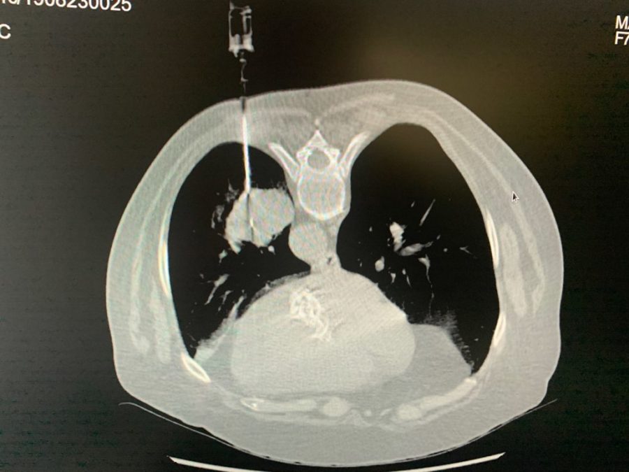 scanner-biopsie-poumon2 | Centre d'imagerie médicale provence
