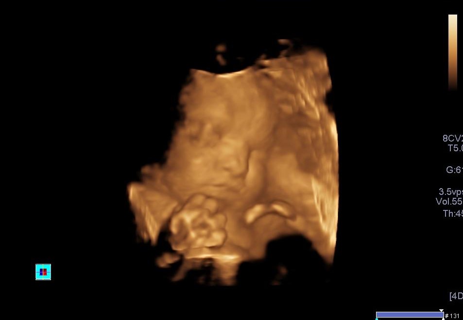 echographie grossesse 3ème trimestre | Centre d'imagerie médicale provence