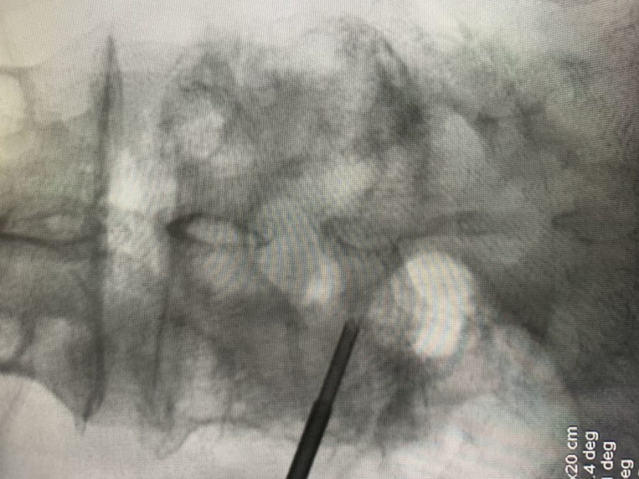 radiographie-Biopsie-discale2-1024x768 | Centre d'imagerie médicale ...