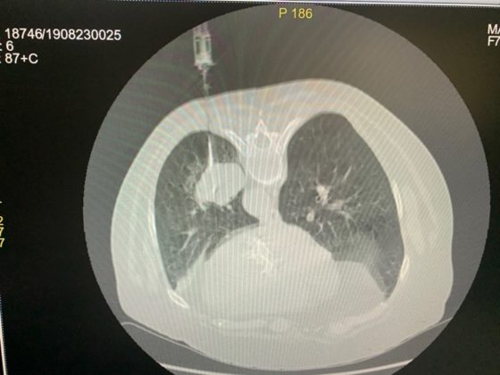 scanner-biopsie-poumon1 | Centre d'imagerie médicale provence