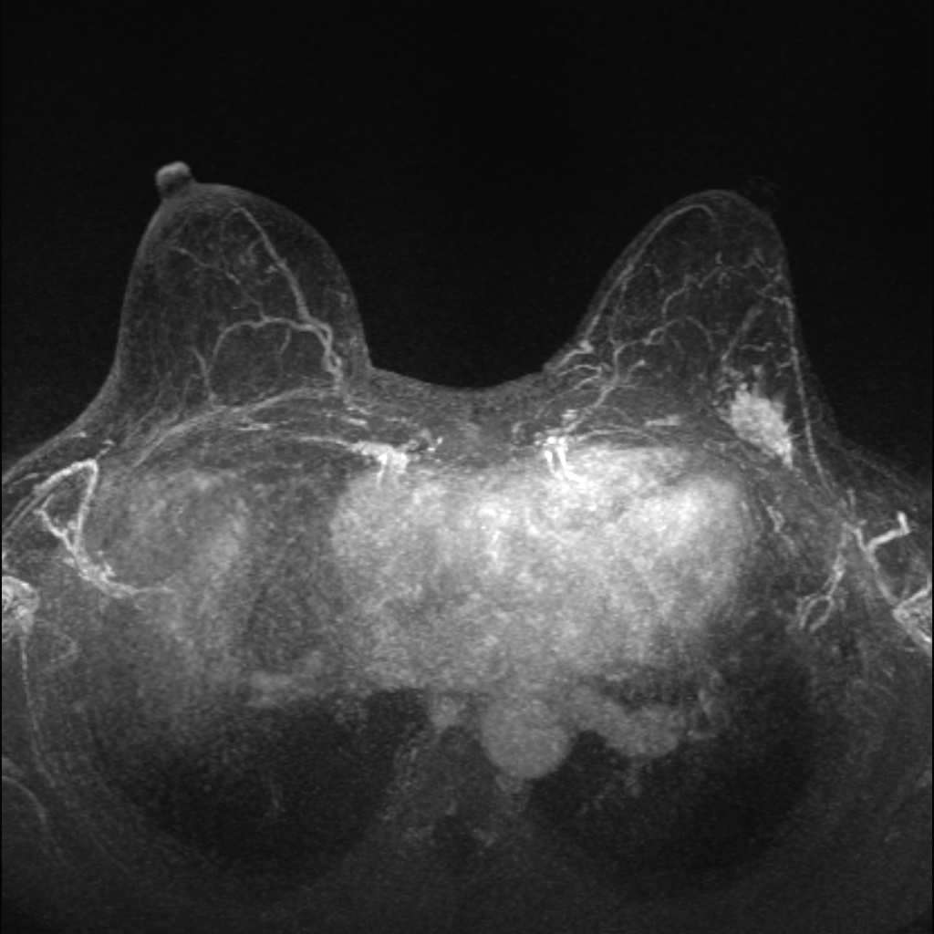 irm mammaire1 | Centre d'imagerie médicale provence