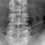 infiltration-lombaire-articulaire-posterieure-2 | Centre d'imagerie ...